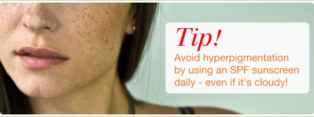 Hyperpigmentation - South Beach Skincare - LifeCell